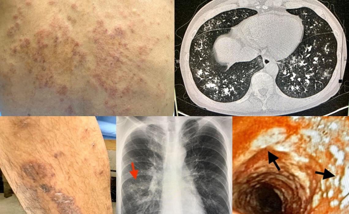 โรคหายาก! 10 ในล้านคน “หลอดเลือดเล็กอักเสบ” - แพทย์ทางเลือก.com